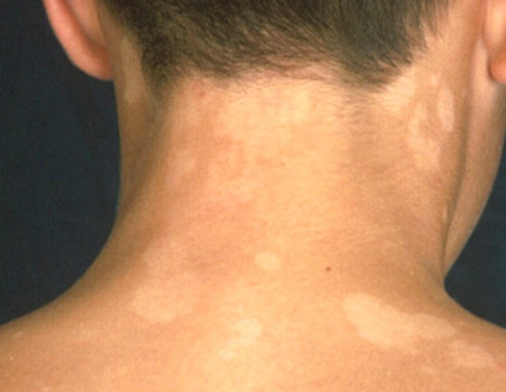 Jiotes en La Piel ¿Por qué Salen y Cómo Quitar los Jiotes del Rostro?